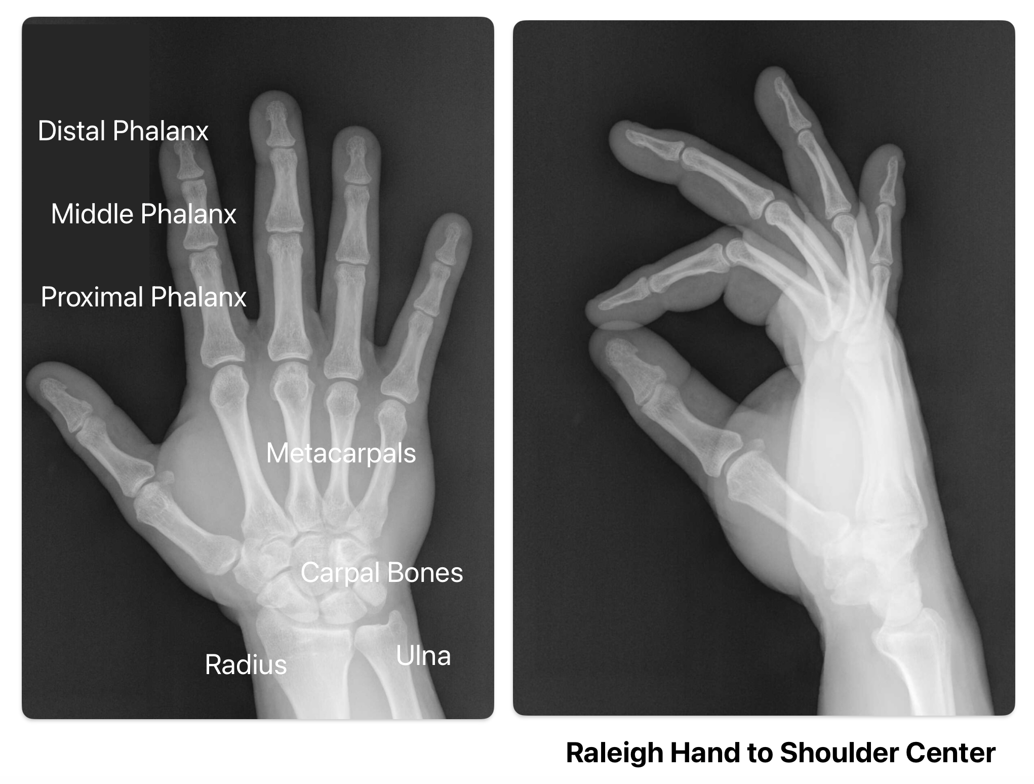 Finger Fracture - Raleigh Hand to Shoulder Center