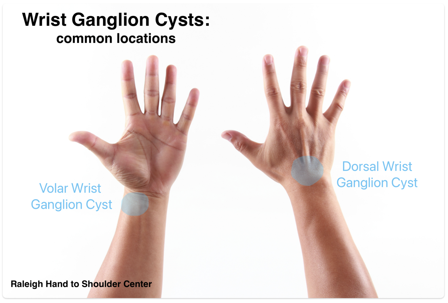 Ganglion Cyst - Raleigh Hand to Shoulder Center