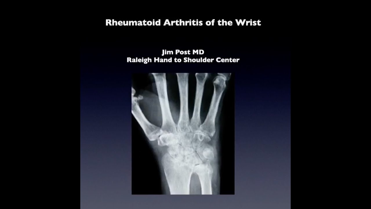 Dr Post discusses Rheumatoid Arthritis - Raleigh Hand to Shoulder Center