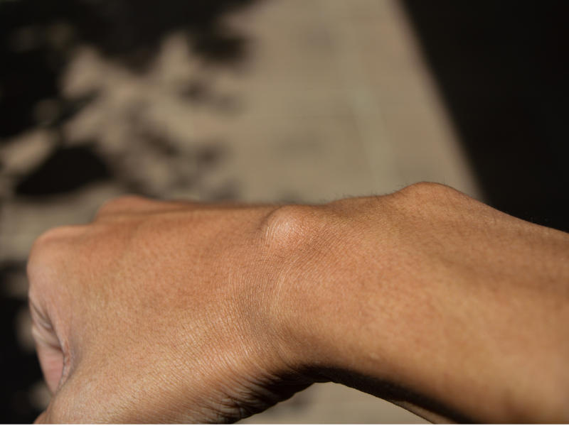 Ganglion Cyst - Raleigh Hand to Shoulder Center